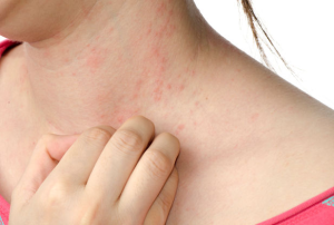 NEURODERMATITIS - Dr. Sandip Agrawal