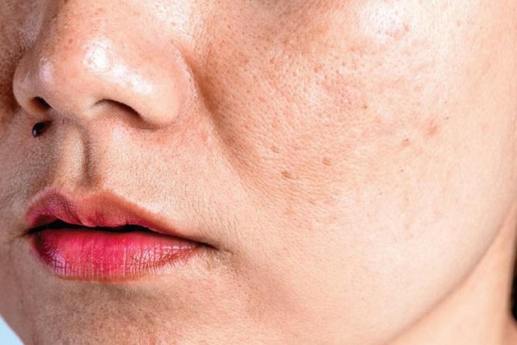 PIGMENTATION - Dr. Sandip Agrawal